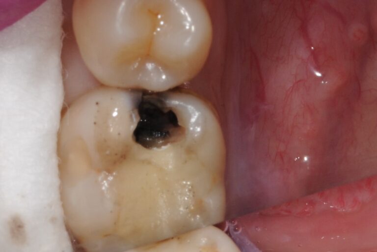 Silver Diamine Fluoride Clinical Cases - Centrix