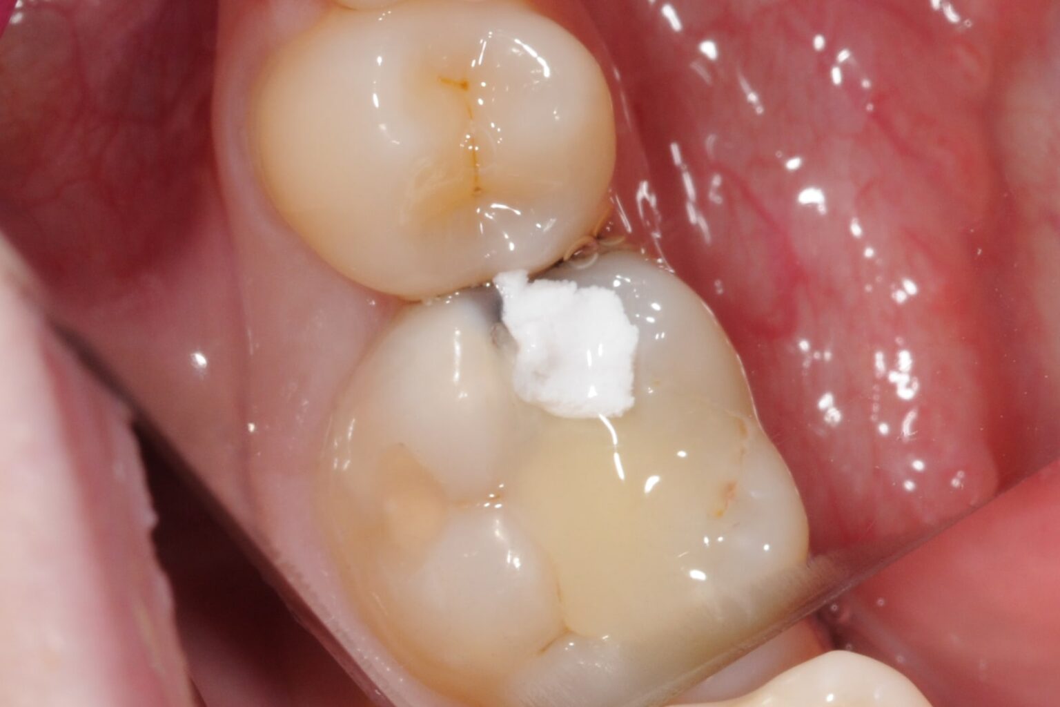 Silver Diamine Fluoride Clinical Cases - Centrix