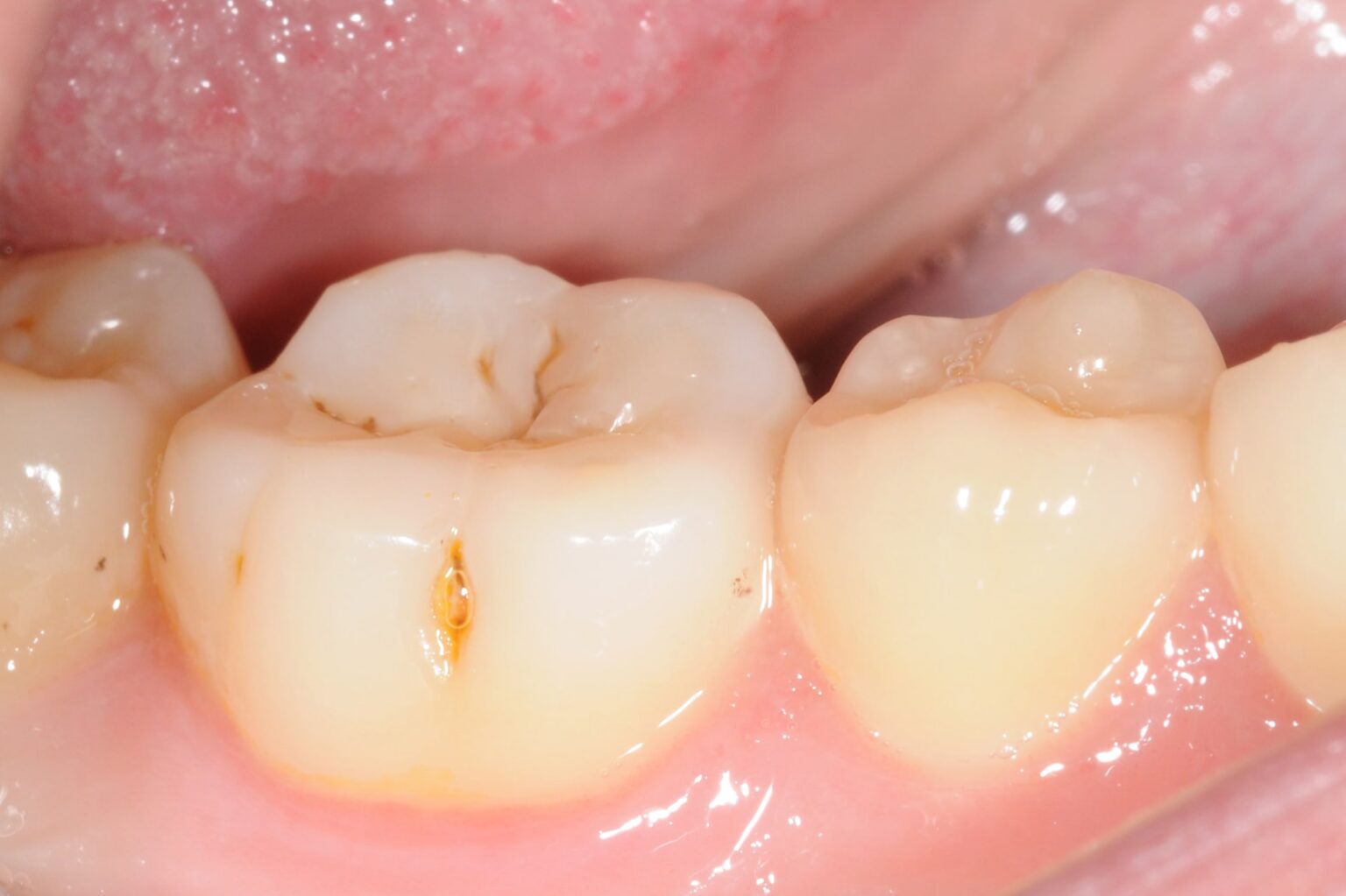 Silver Diamine Fluoride Clinical Cases - Centrix