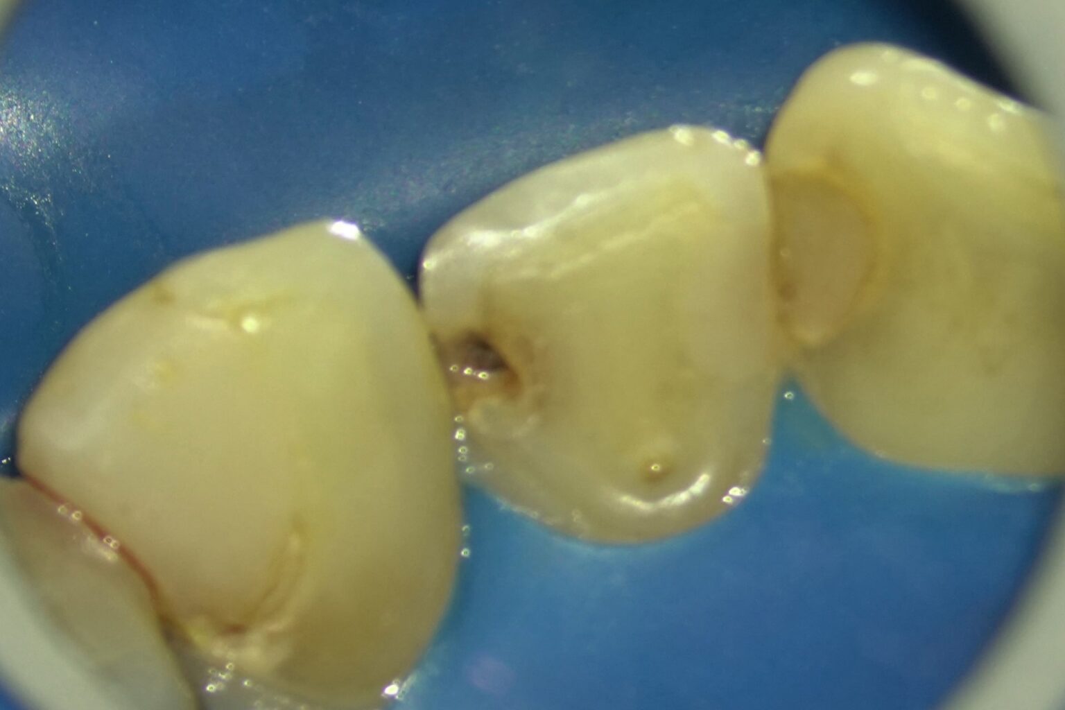 Silver Diamine Fluoride Clinical Cases - Centrix