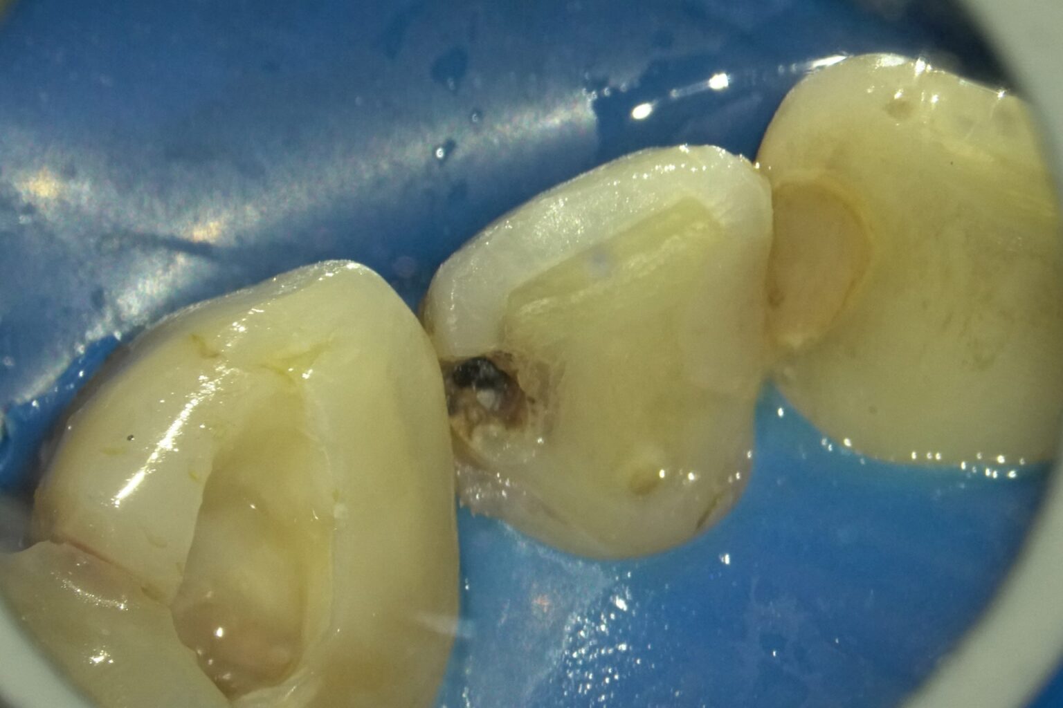 Silver Diamine Fluoride Clinical Cases - Centrix