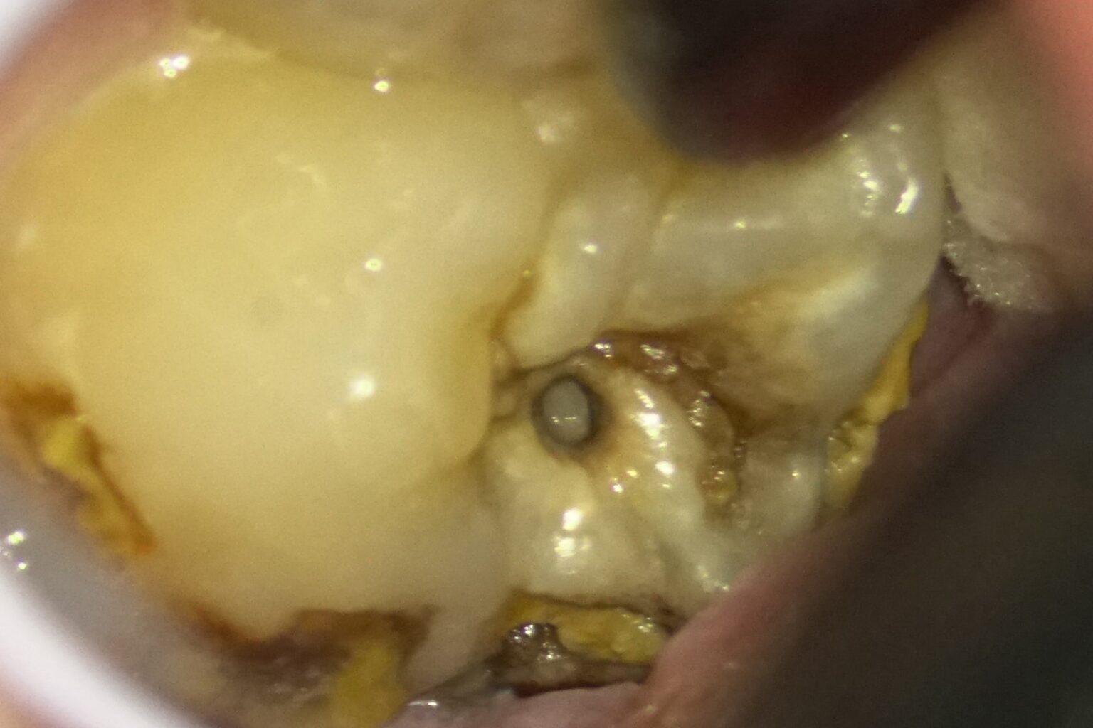 Silver Diamine Fluoride Clinical Cases - Centrix
