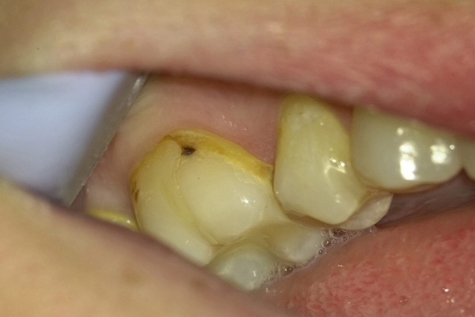 Silver Diamine Fluoride Clinical Cases - Centrix