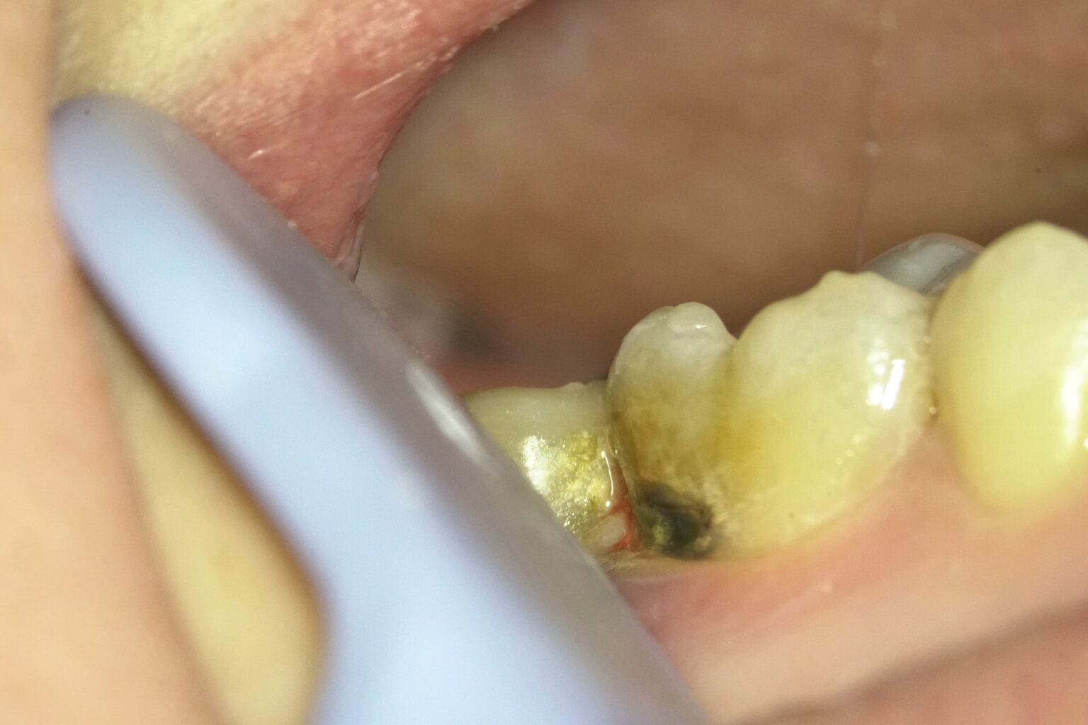 Silver Diamine Fluoride Clinical Cases - Centrix