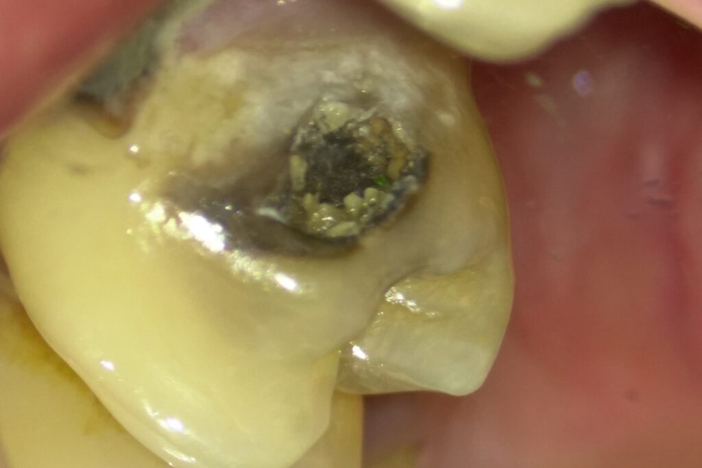 Silver Diamine Fluoride Clinical Cases - Centrix
