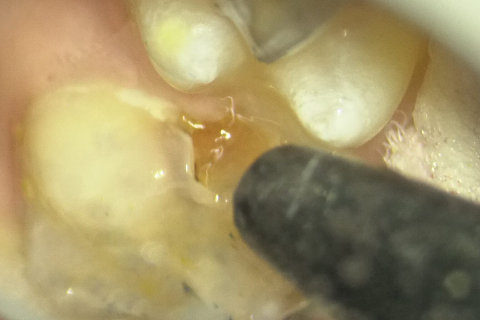 Silver Diamine Fluoride Clinical Cases - Centrix