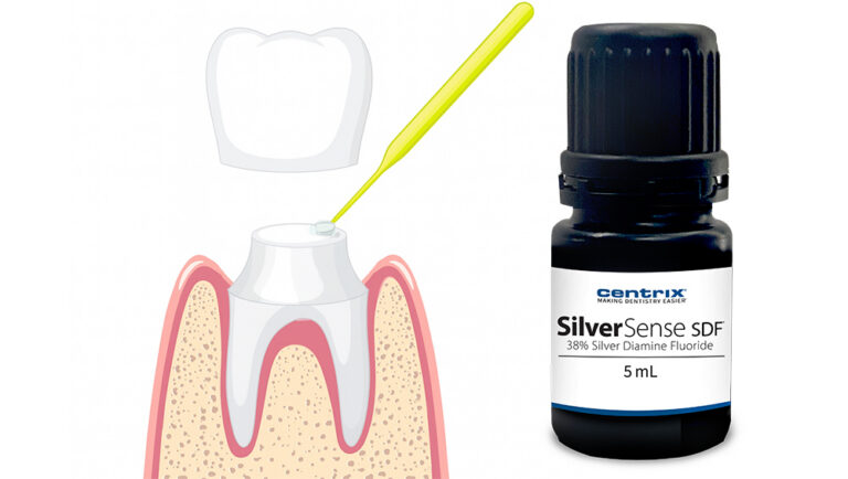 Silver Diamine Fluoride in your Restorative Process - Centrix